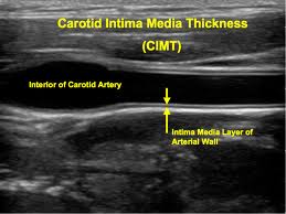 Carotid Intima-Media Thickness (CIMT) Ultrasound Screening | Dr. Adam ...